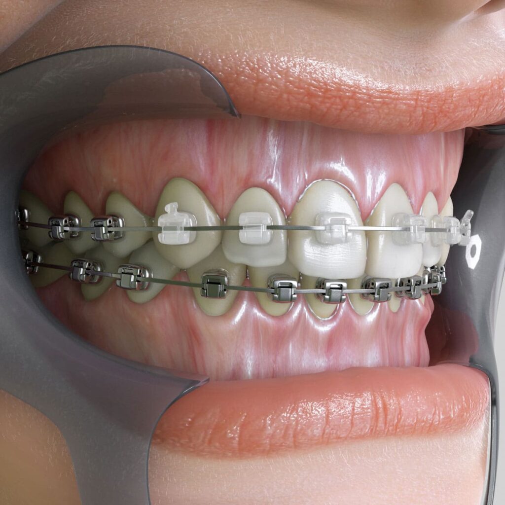 What Is Temporary Prosthesis In Implant Treatment?