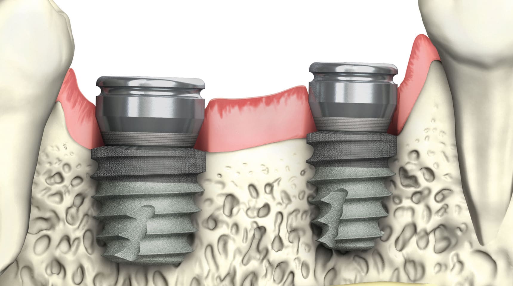 Mini İmplant - Mini Diş İmplantları Tedavisi | EKİZ KLİNİK