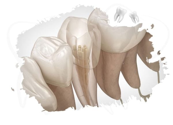 Regenerative Endodontic Treatment - Ekiz Diş Kliniği