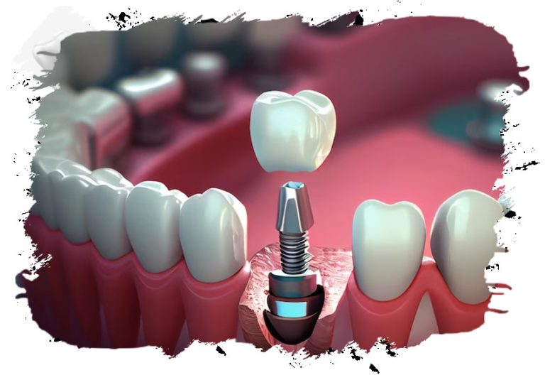 What is All-on-4? Who Can Get All-on-4 Treatment? How Long Does it Take ...
