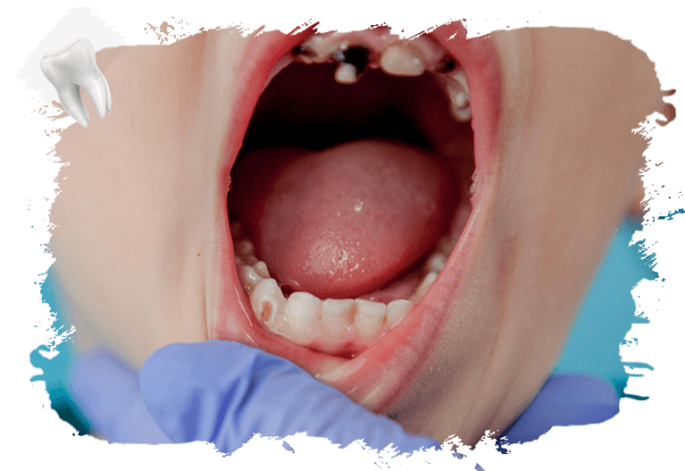 What Is Gum Papilla Loss? How Is It Treated? - Ekiz Dental Clinic